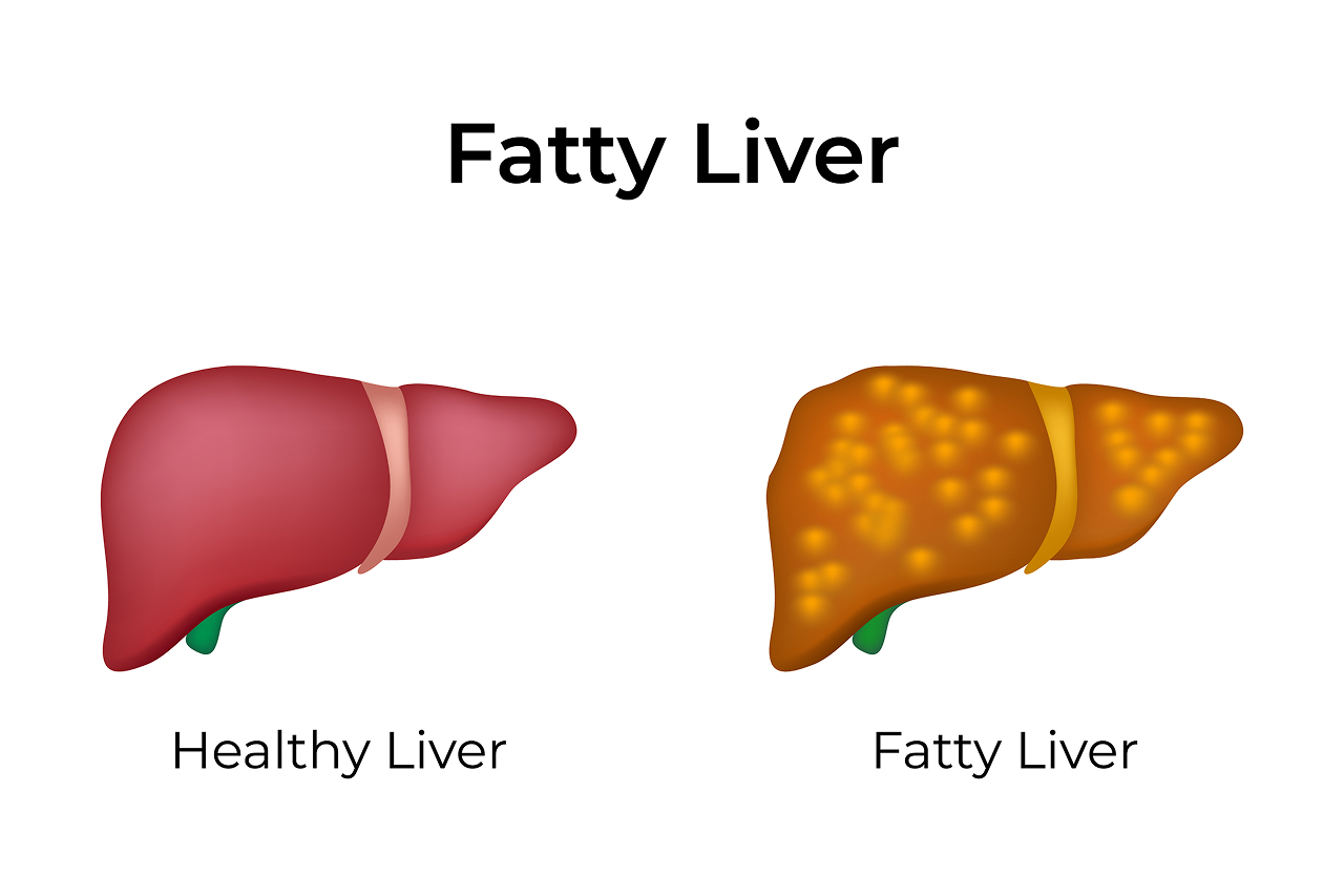 How Long it Takes to Reverse Fatty Liver? Timelines and Expectations
